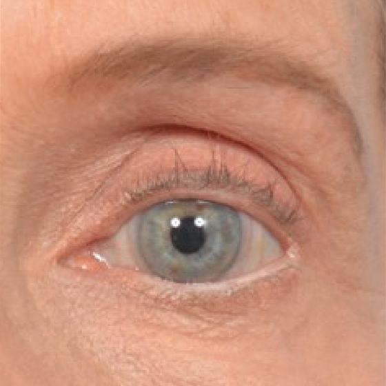 TempSure LidLift™ - Cynosure