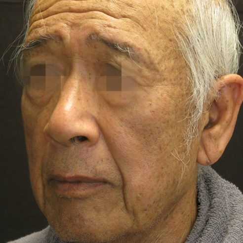 Skin Revitalization and Tattoo Removal Machine | PicoSure Pro | Cynosure