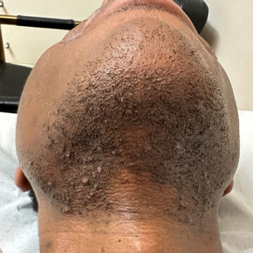 Aesthetic Machine | Elite iQ™ | Cynosure