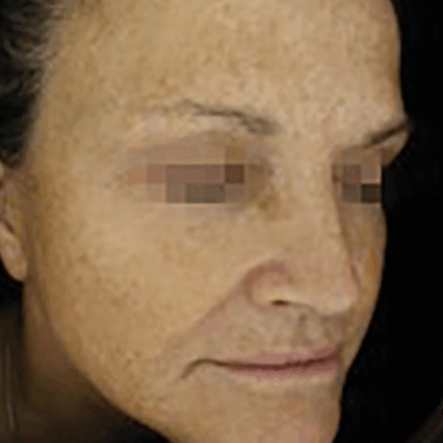 DermaV Vascular & Pigment Laser - Cynosure Lutronic