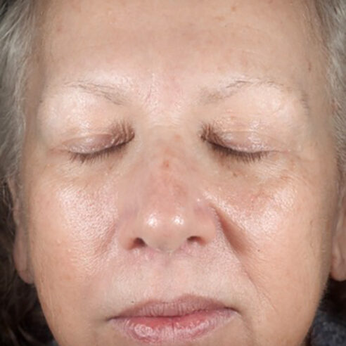 Mosaic 3D Fractional Laser - Cynosure Lutronic